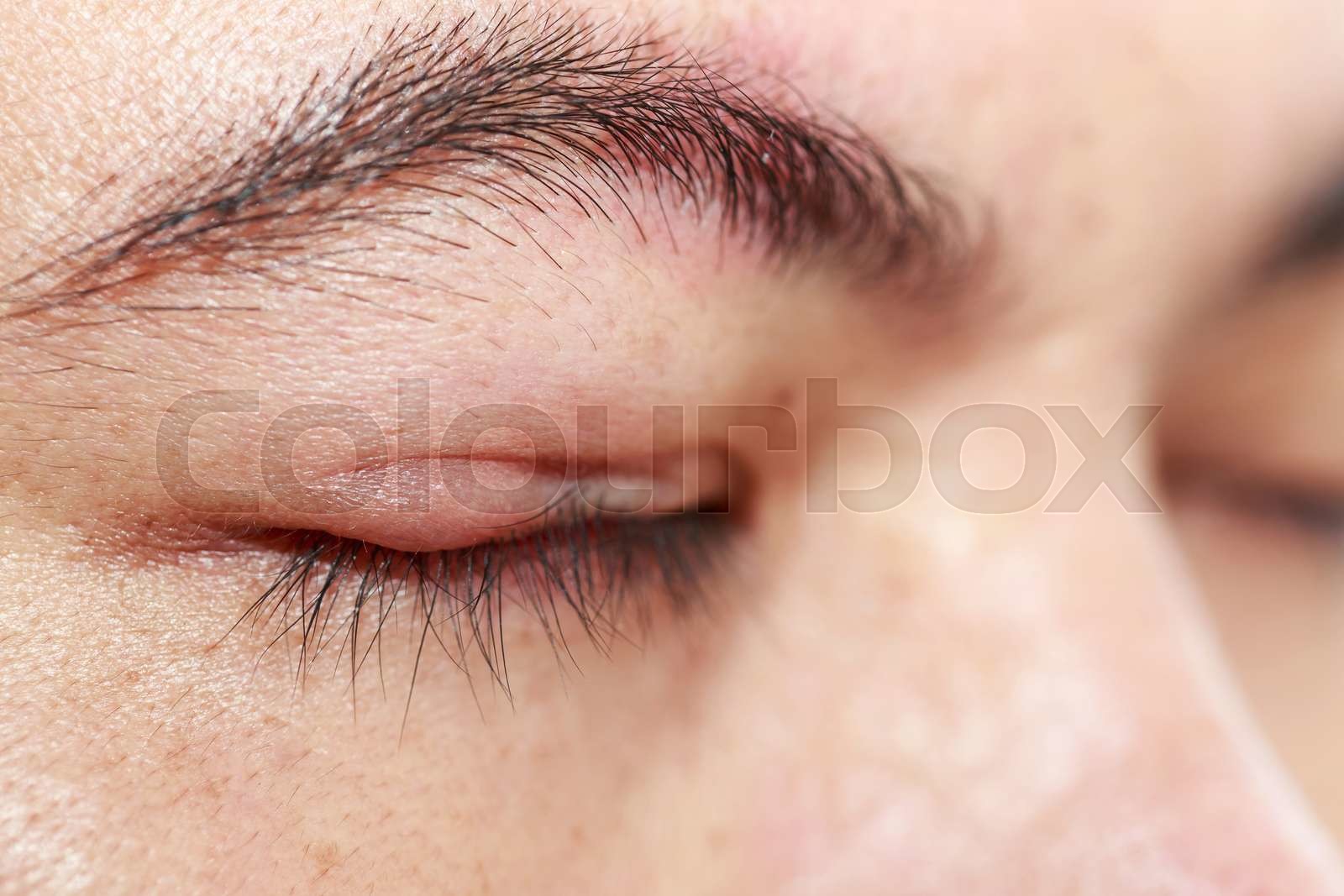 Right upper eye lid abscess "stye or hordeolum" | Stock image | Colourbox