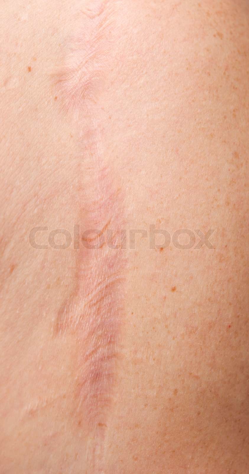 close up of scar on skin | Stock image | Colourbox