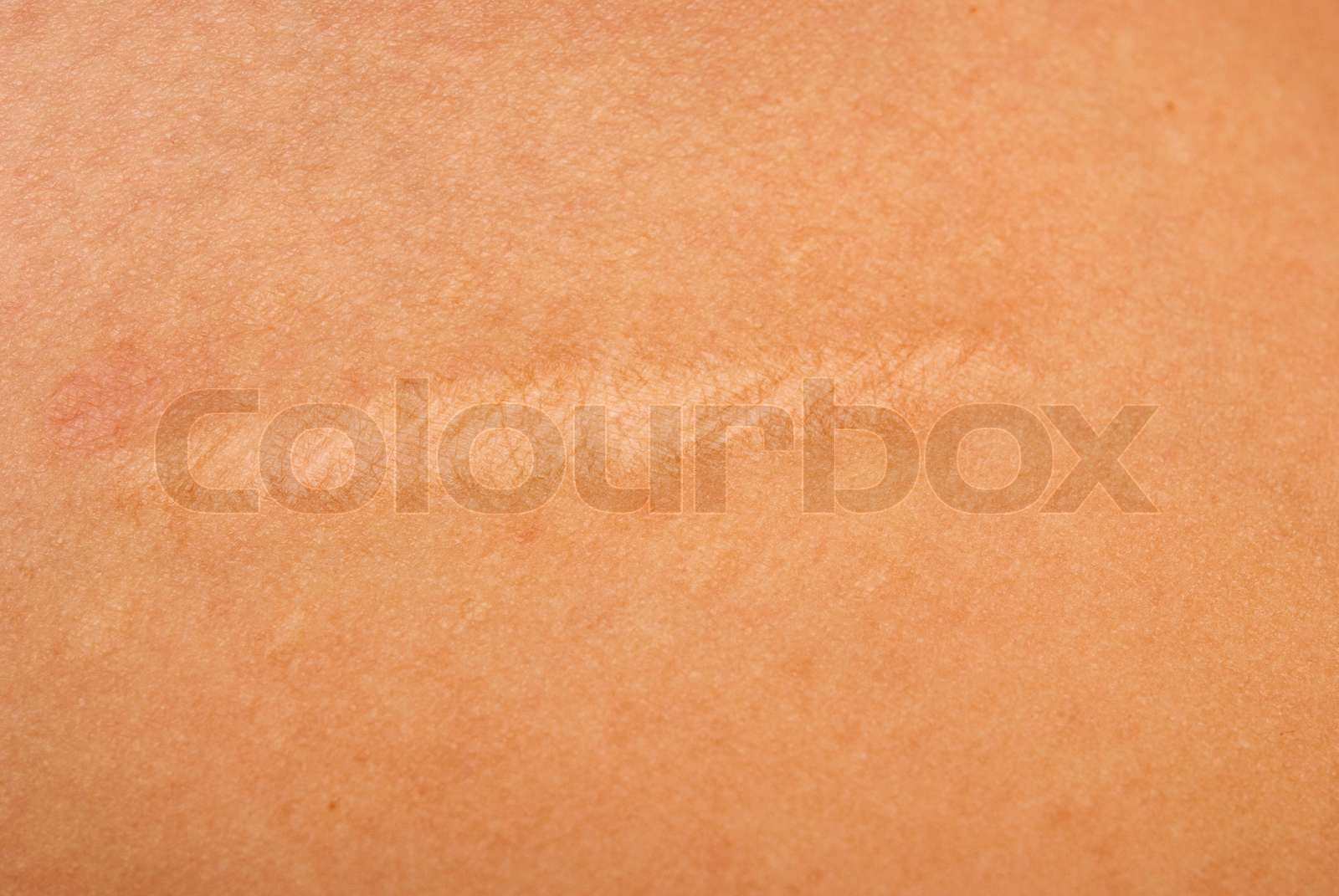close up of scar on skin | Stock image | Colourbox