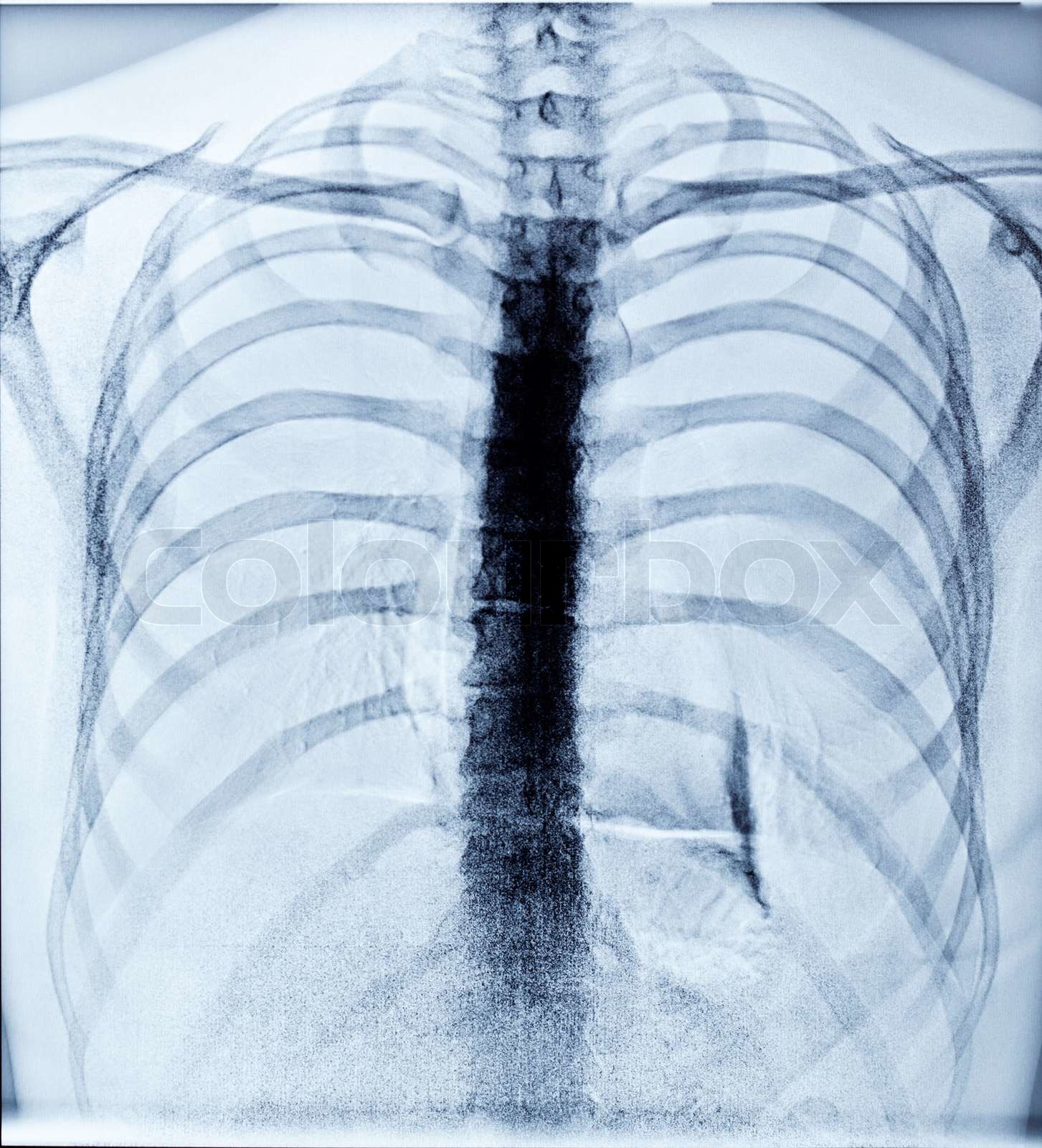 X-Ray Image Of Human Healthy Chest | Stock image | Colourbox