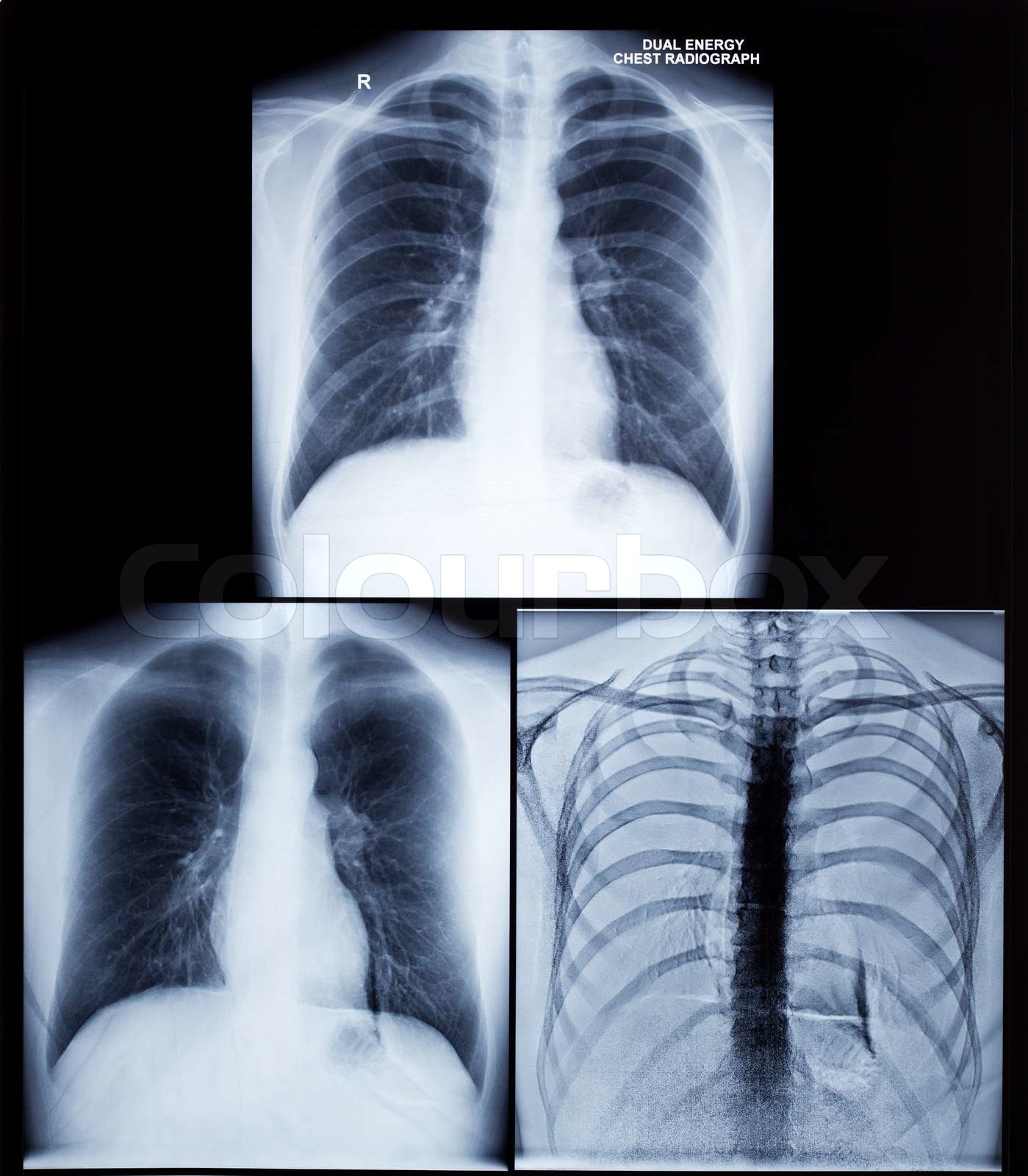 X-Ray Image Of Human Healthy Chest | Stock image | Colourbox