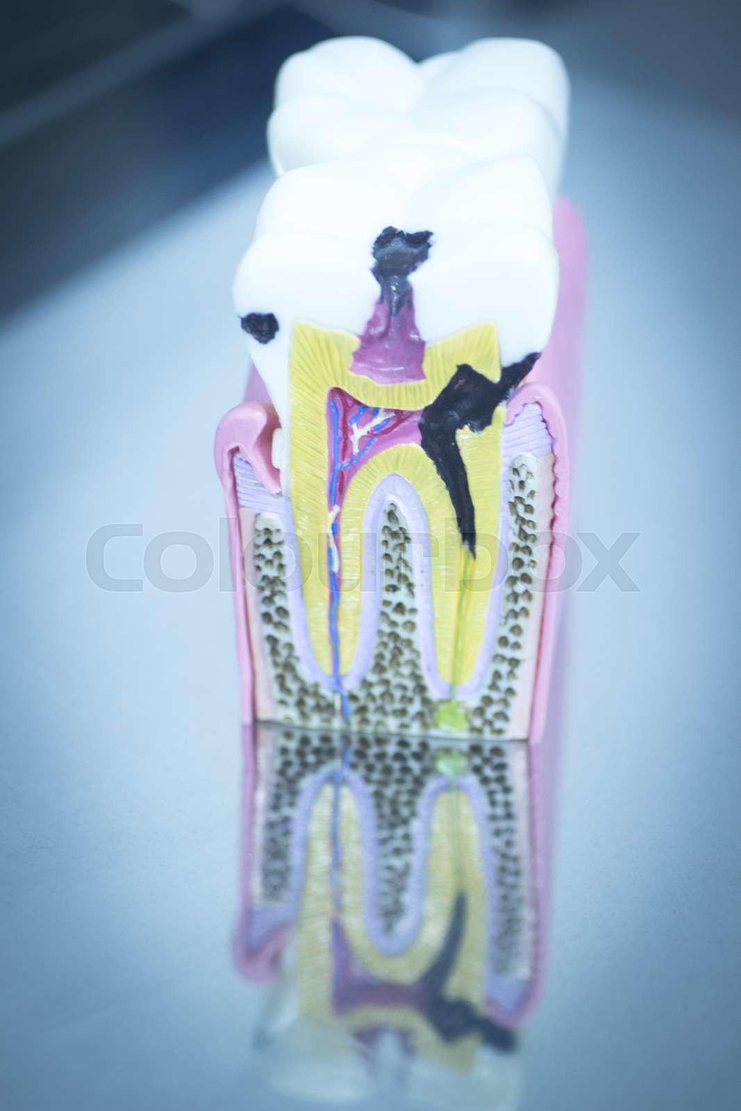 Dental tooth model cast showing decay enamel root | Stock image | Colourbox