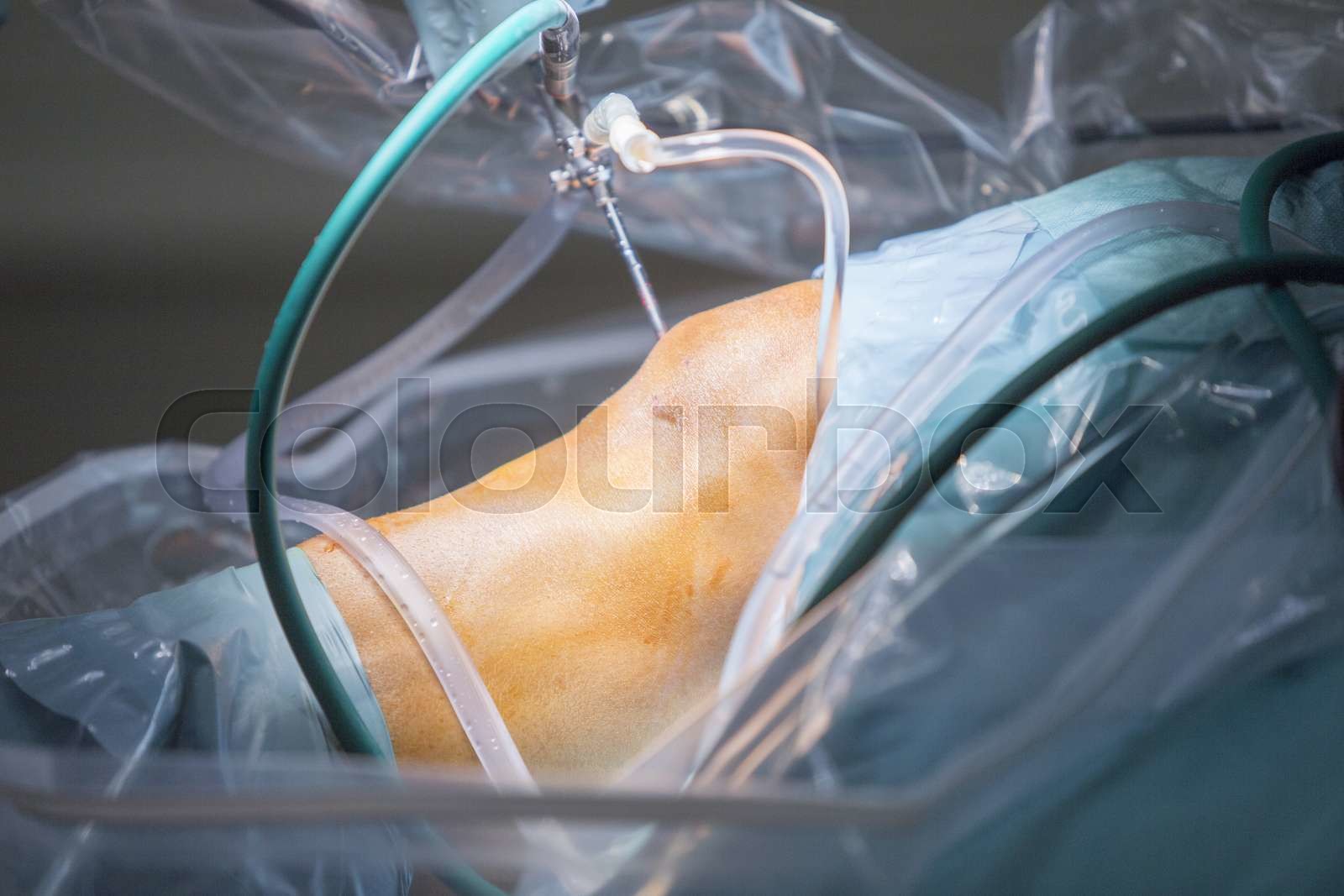 Arthroscopy orthopedic surgery knee arthroscope probe | Stock image ...