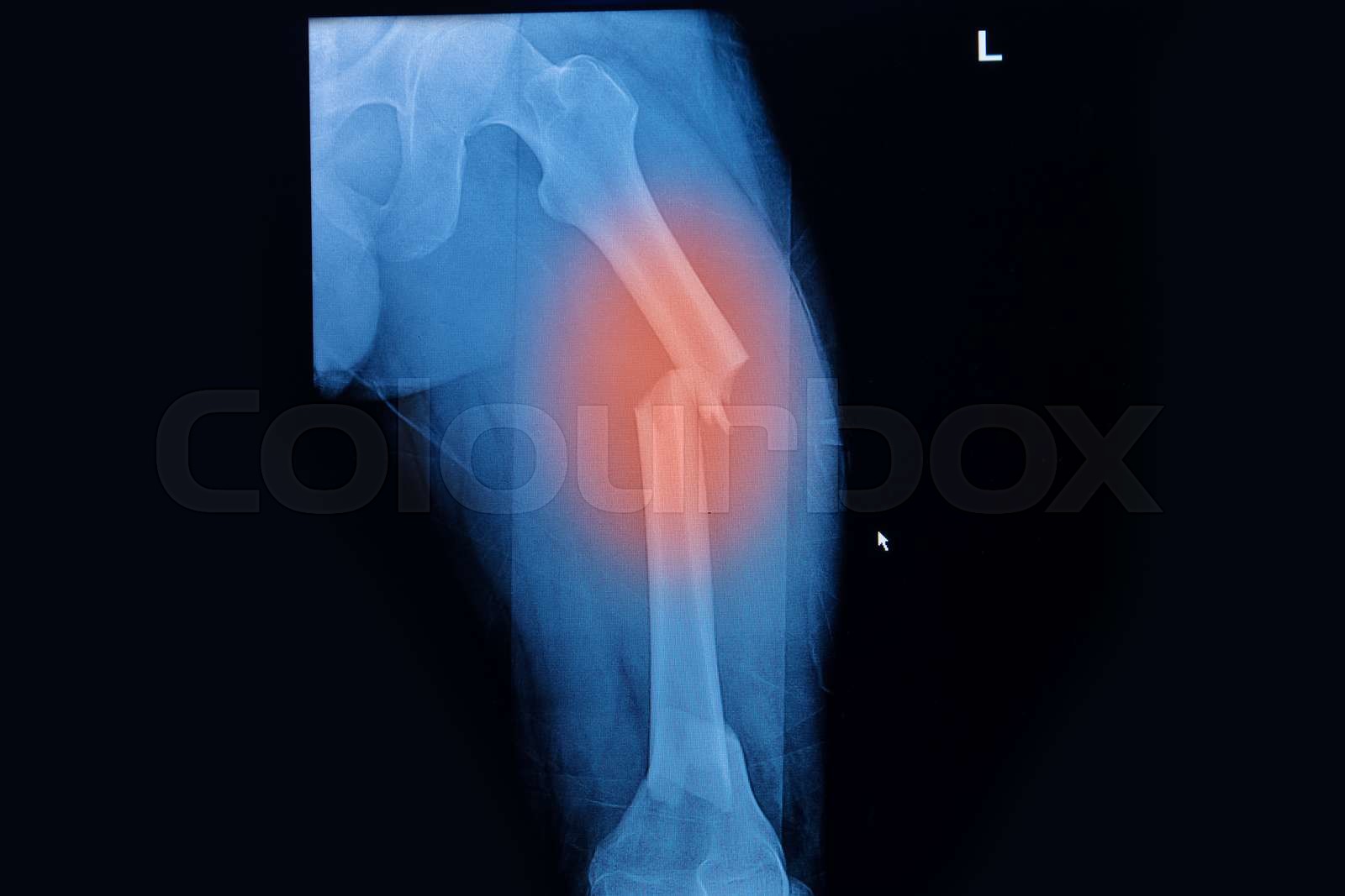 Broken Human Femur X Ray
