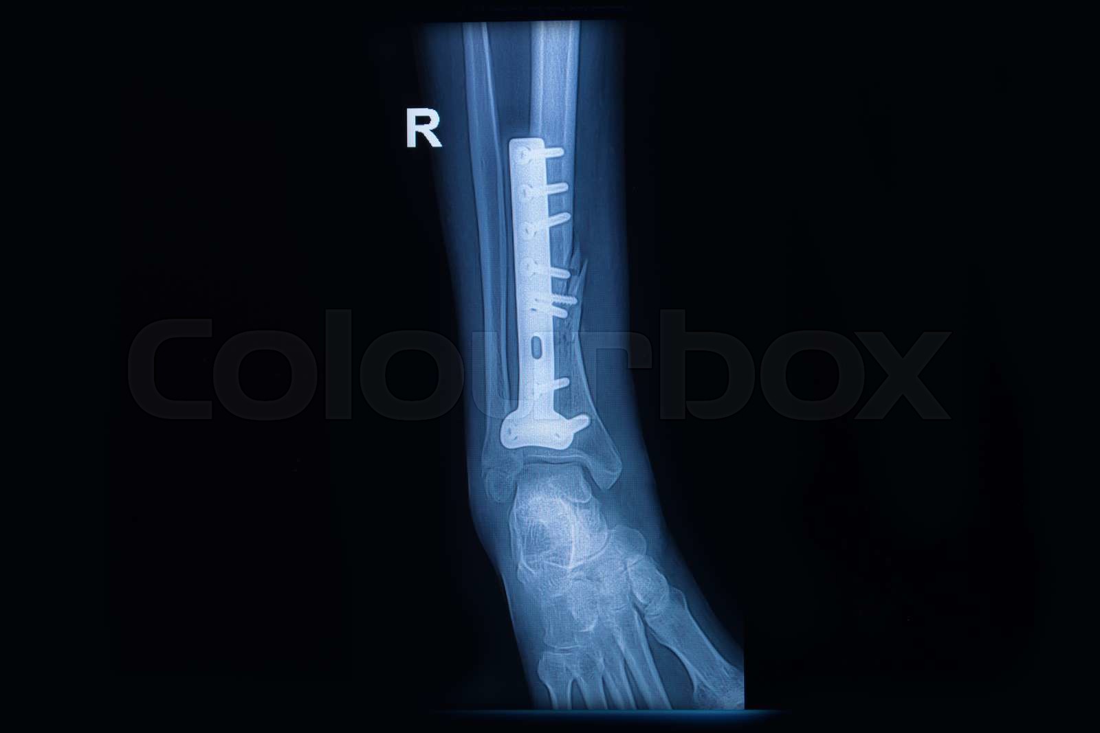 film x-ray ankle show fracture distal tibia | Stock image | Colourbox