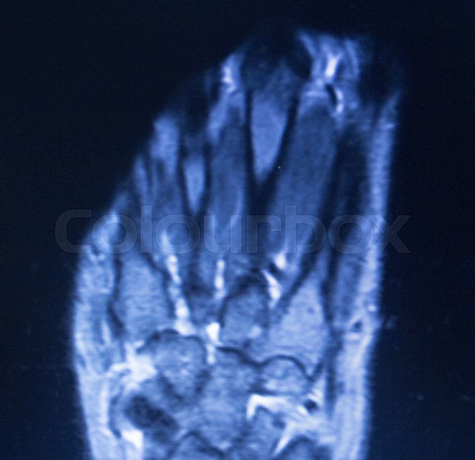 MRI magnetic resonance imaging hand finger scan | Stock image | Colourbox