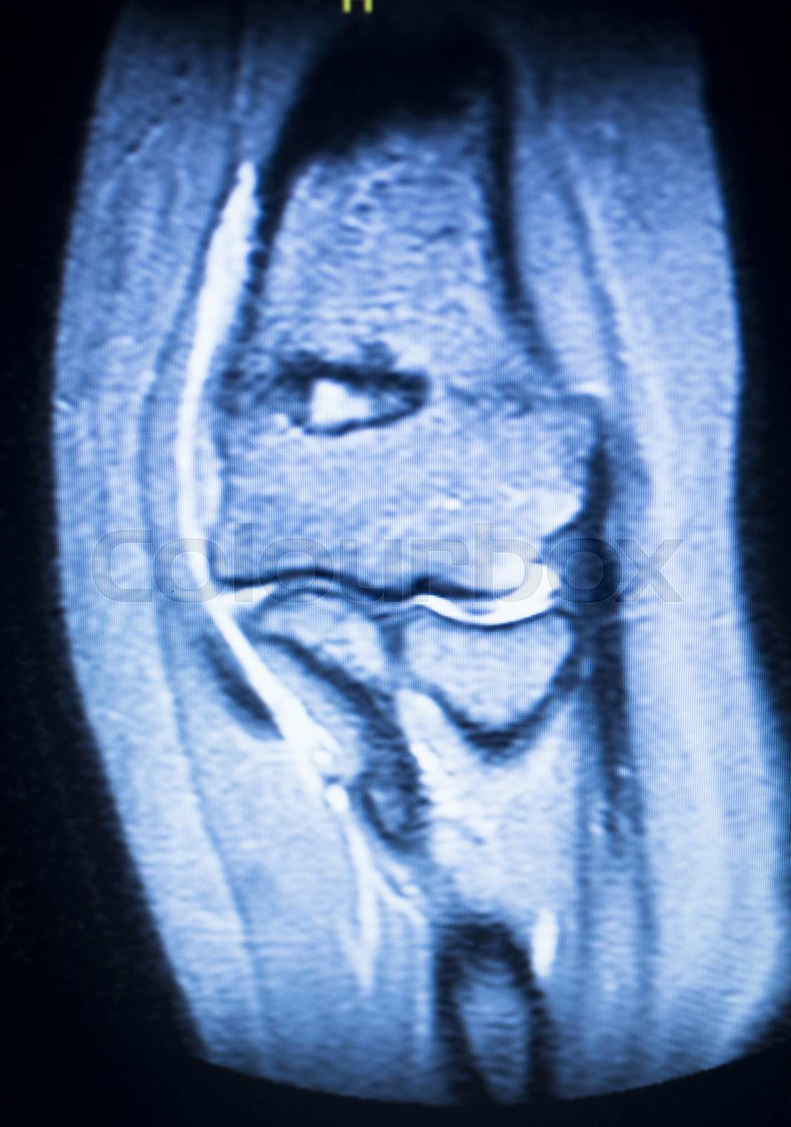 MRI magnetic resonance imaging elbow arm scan | Stock image | Colourbox