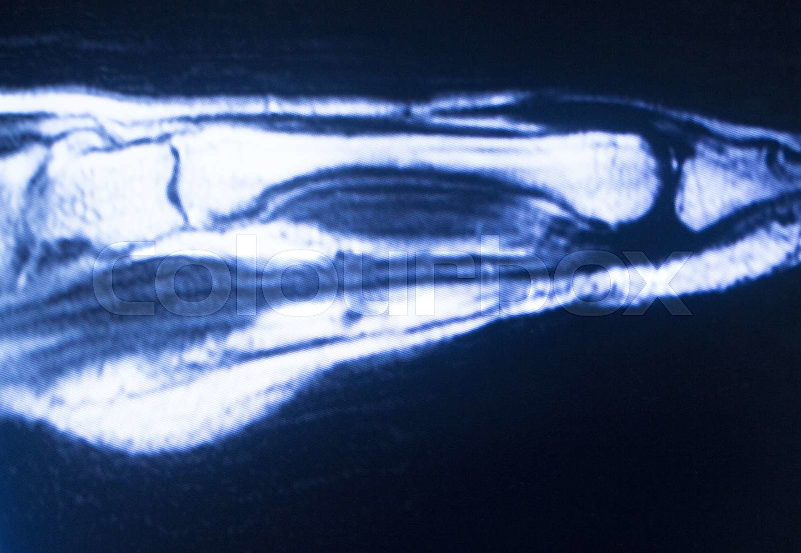 MRI magnetic resonance imaging hand carpal scan | Stock image | Colourbox