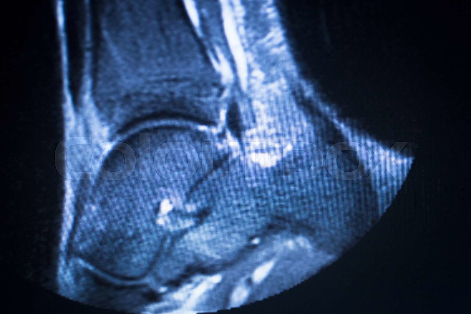 MRI magnetic resonance imaging ankle scan | Stock image | Colourbox
