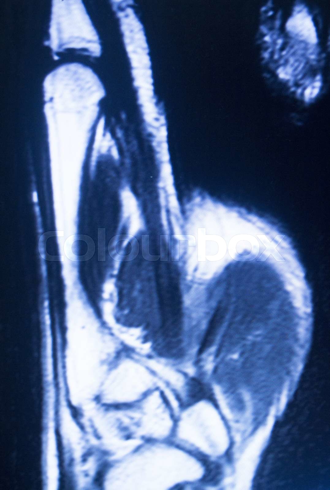 MRI magnetic resonance imaging hand carpal scan | Stock image | Colourbox