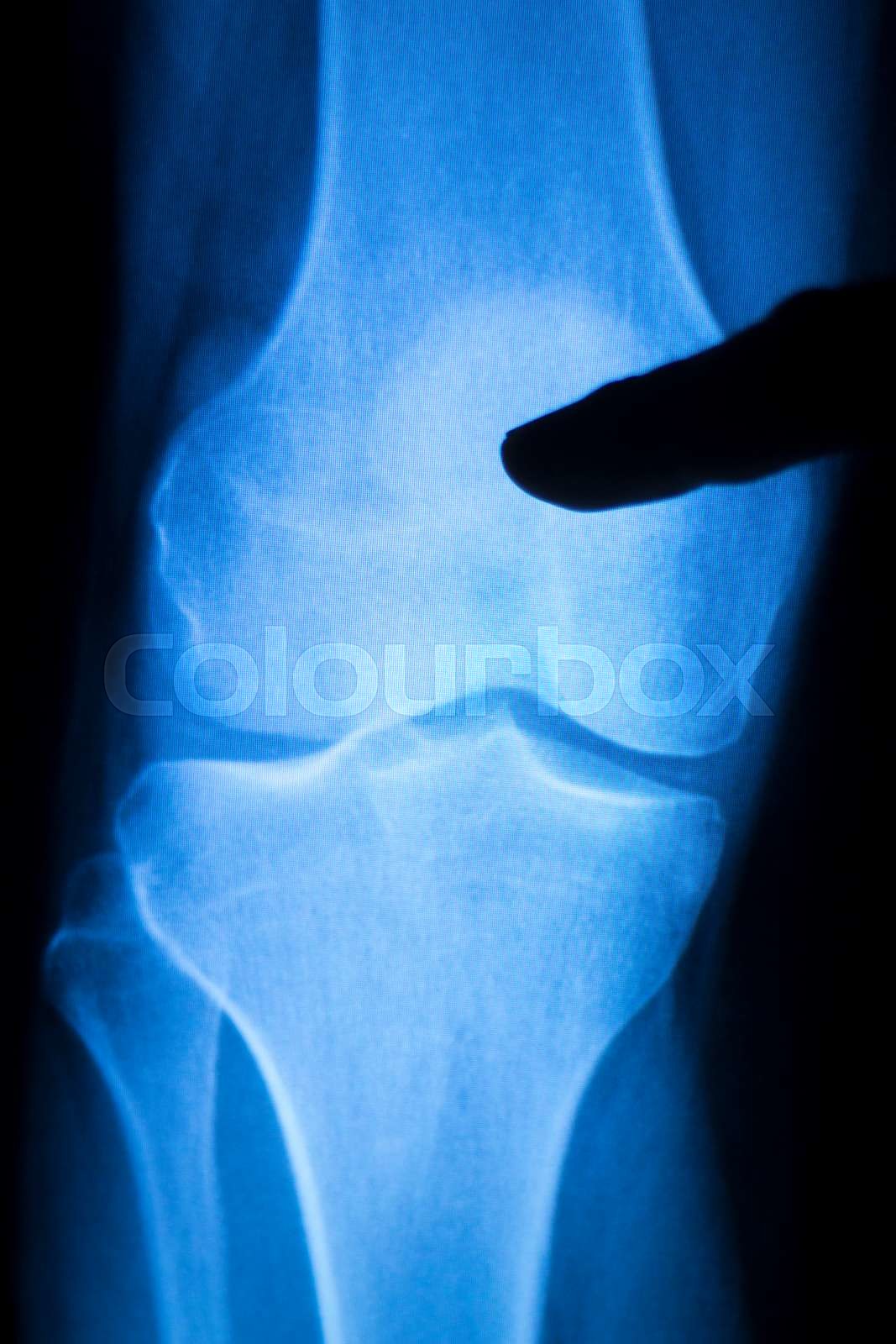 Knee joint meniscus x-ray test scan | Stock image | Colourbox