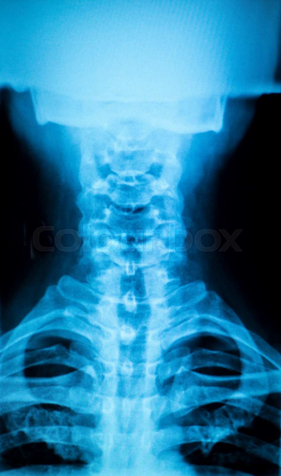Kneck and spine injury x-ray scan | Stock image | Colourbox