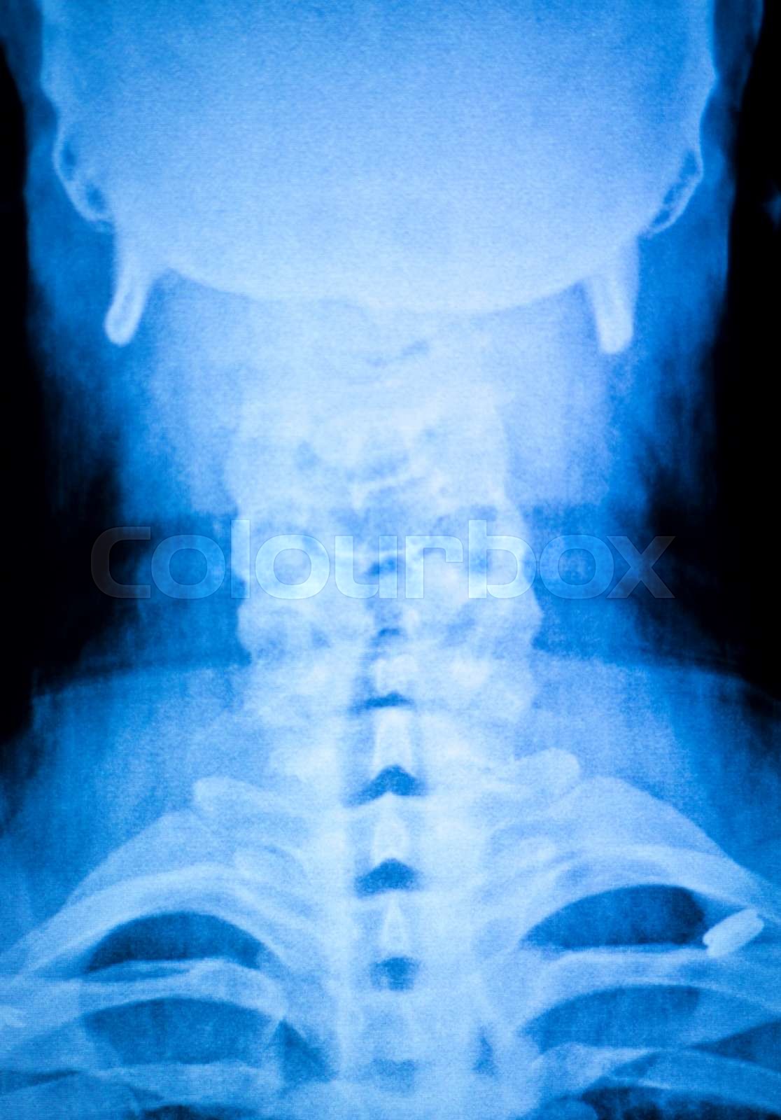 Kneck and spine injury x-ray scan | Stock image | Colourbox