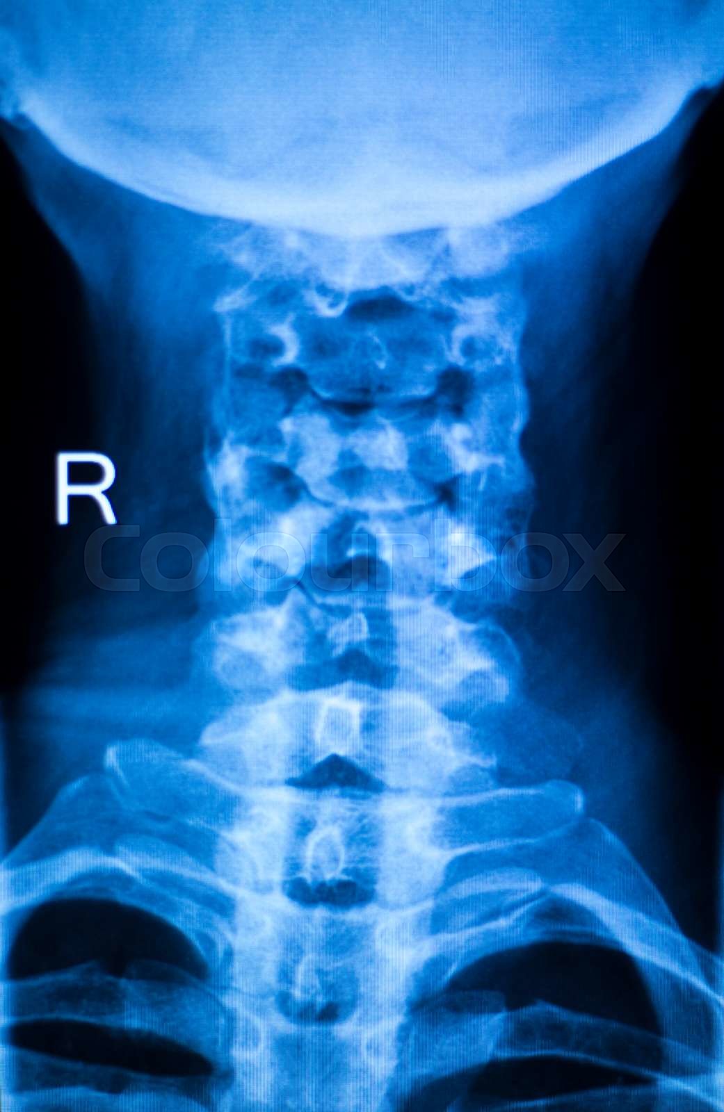 Kneck and spine injury x-ray scan | Stock image | Colourbox