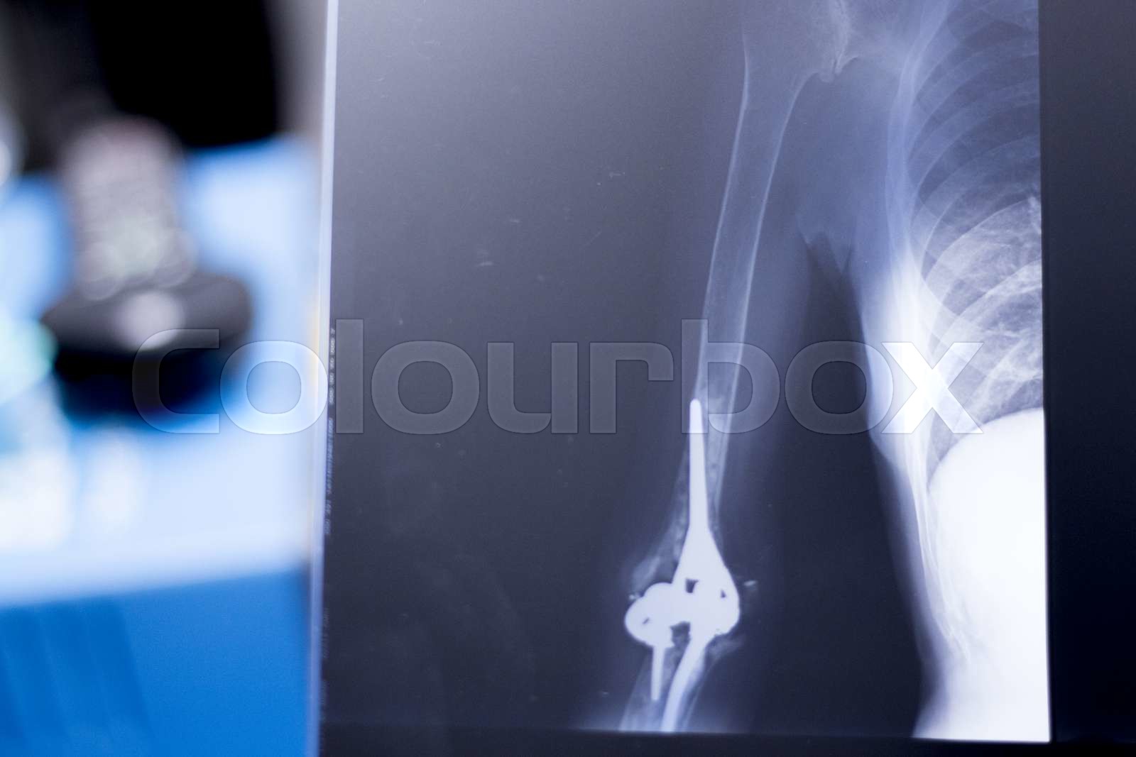 Surgical implant arm elbow xray test scan | Stock image | Colourbox