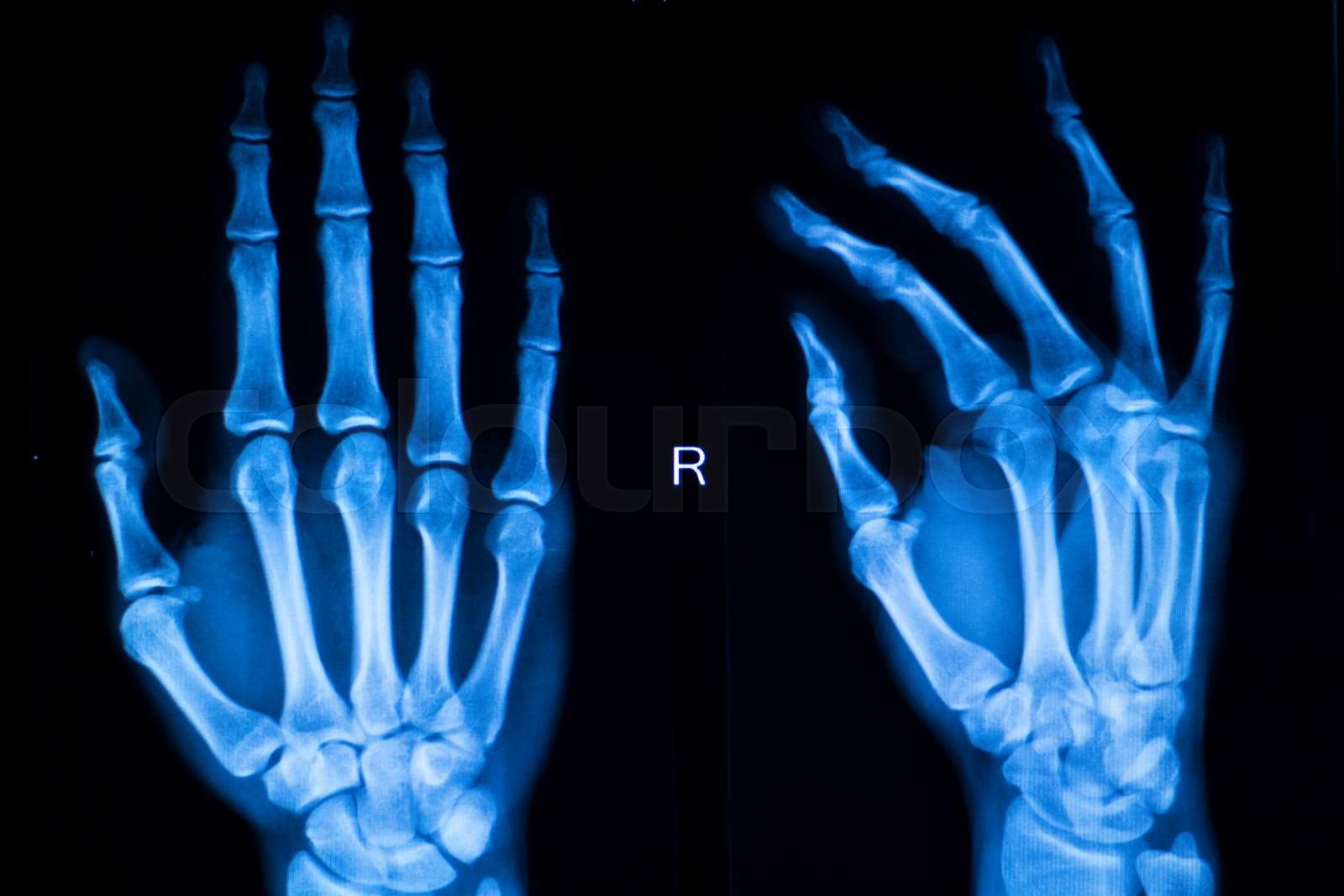 Hand finger thumb hospital xray scan | Stock image | Colourbox