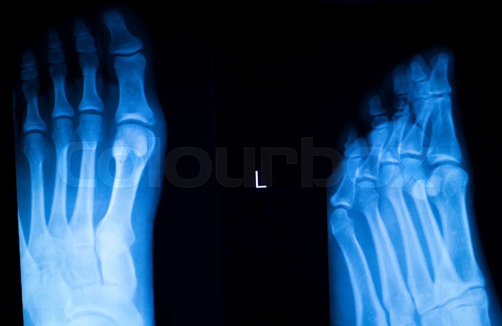Foot and toes injury x-ray scan | Stock image | Colourbox