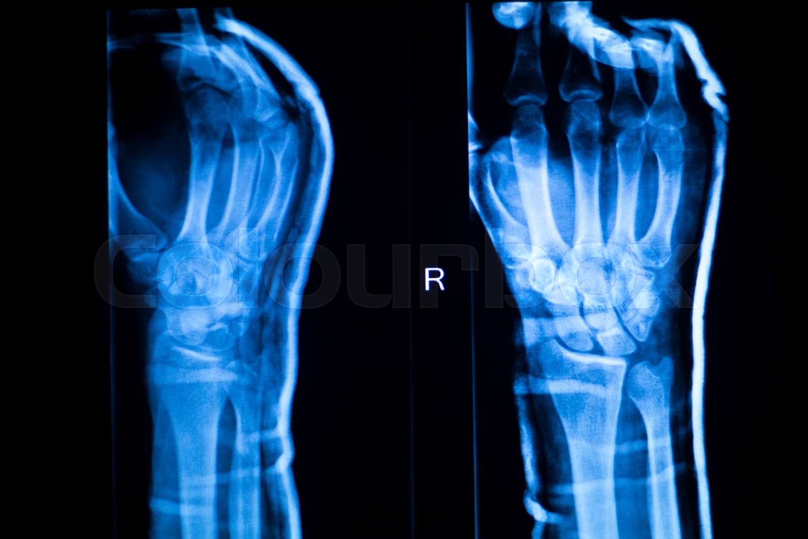 Hand finger thumb hospital xray scan | Stock image | Colourbox