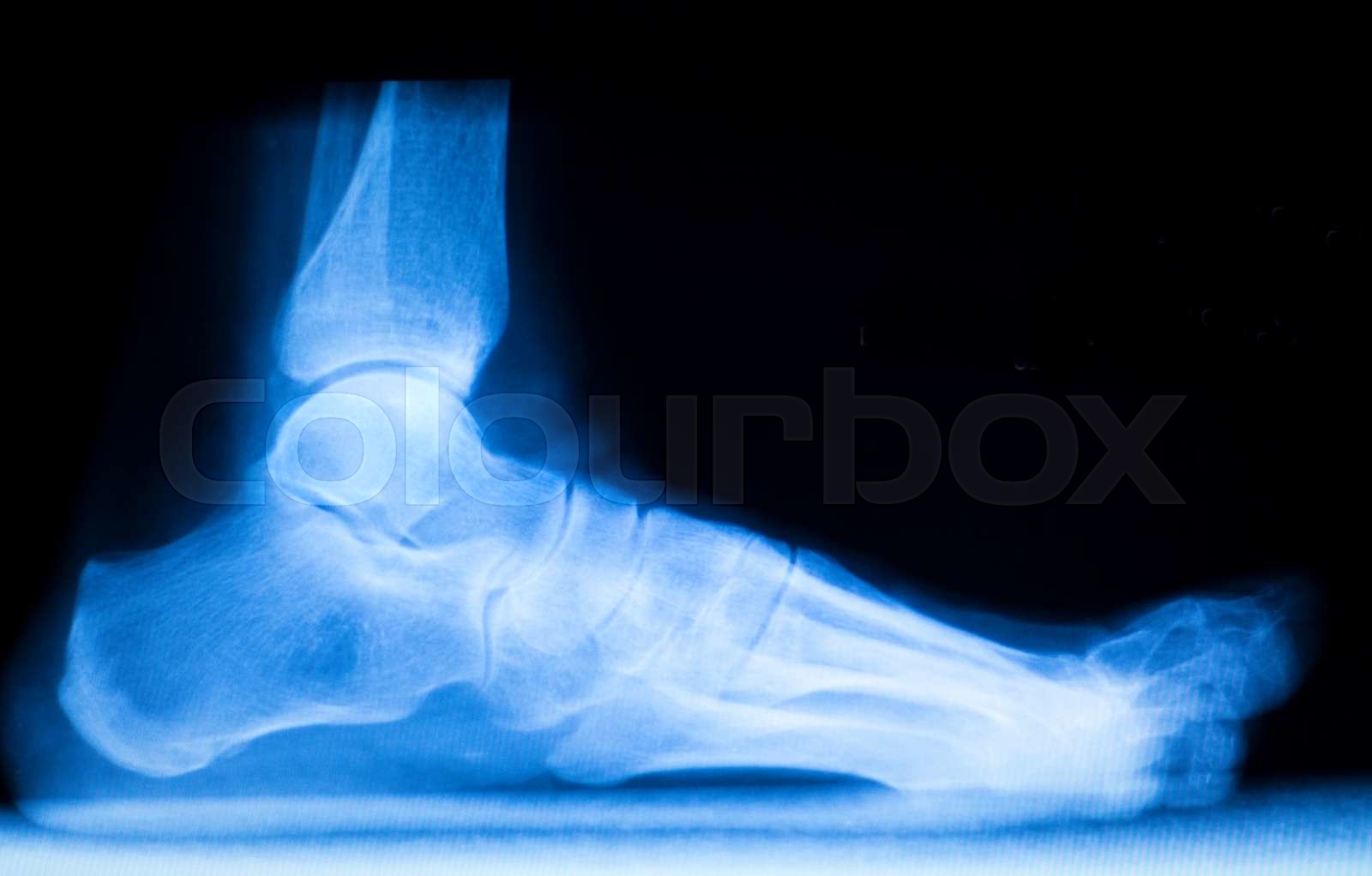 Foot and toes injury x-ray scan | Stock image | Colourbox