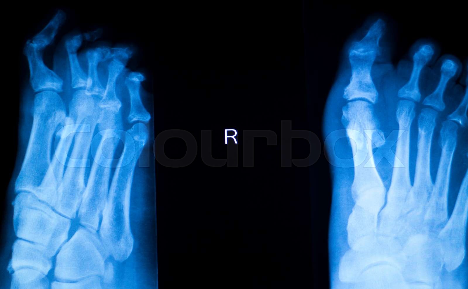 Foot and toes injury x-ray scan | Stock image | Colourbox