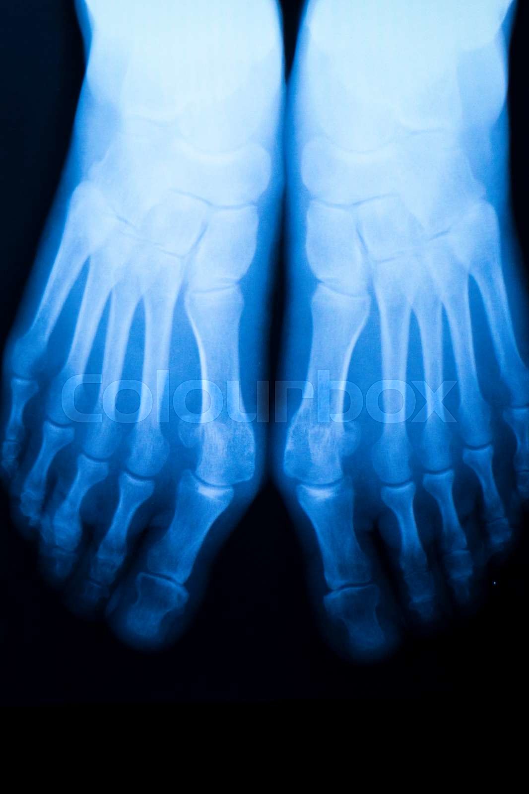 Foot and toes injury x-ray scan | Stock image | Colourbox
