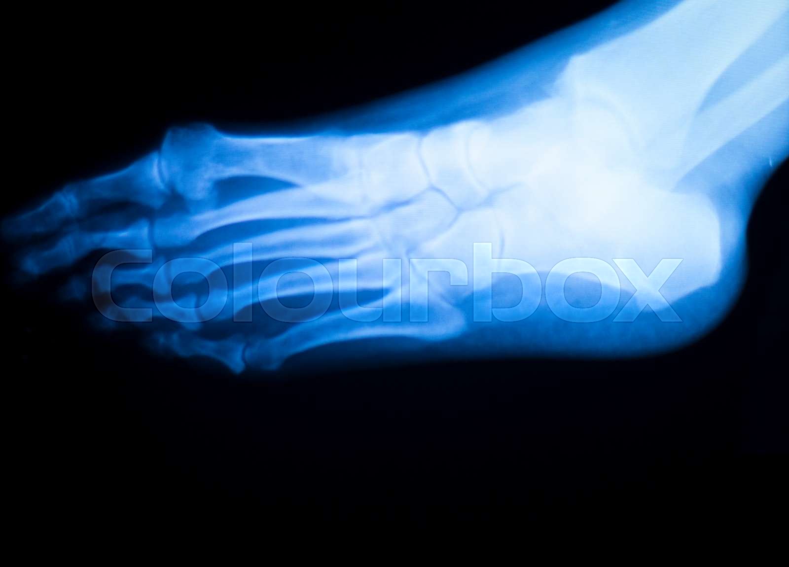 Foot and toes injury x-ray scan | Stock image | Colourbox