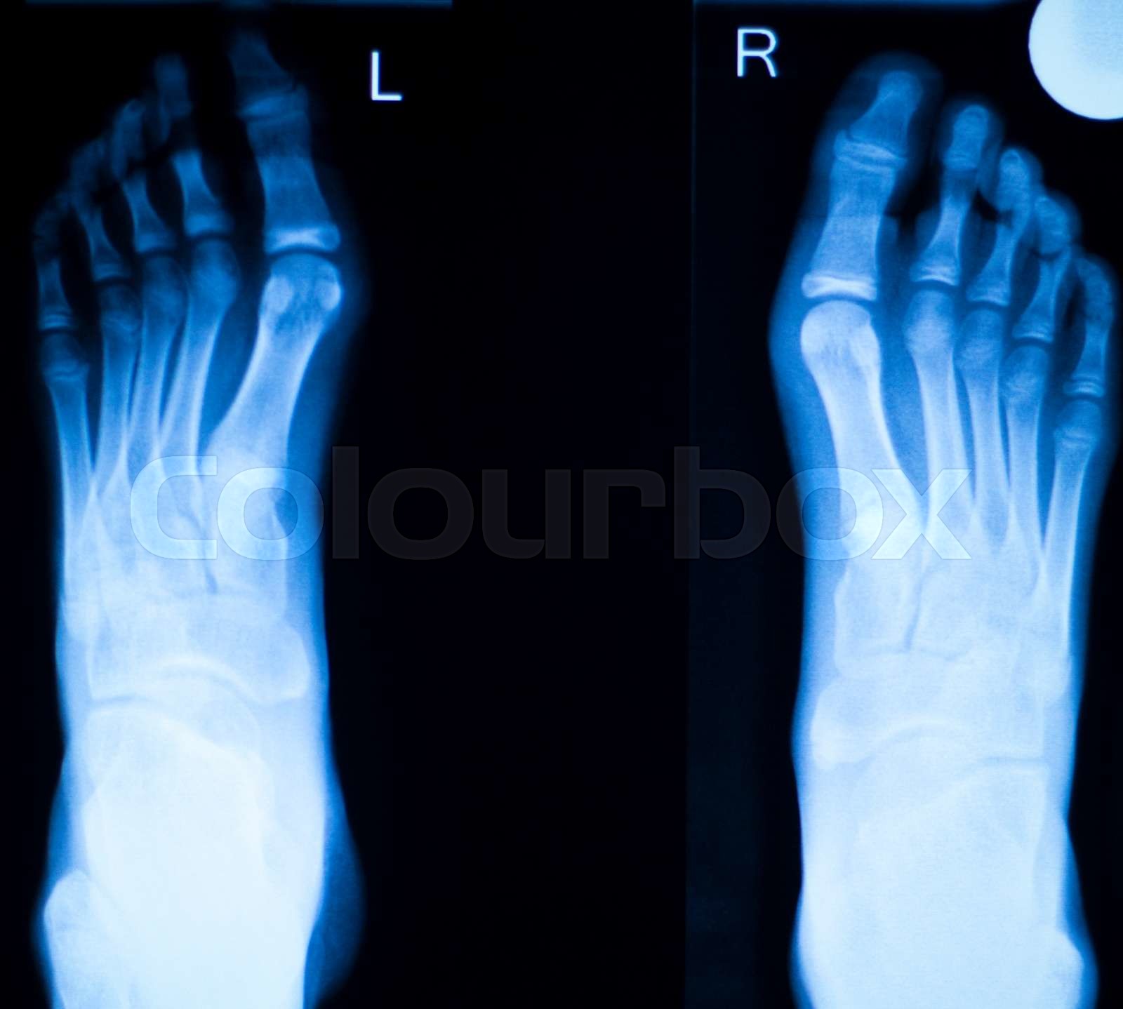 Foot and toes injury x-ray scan | Stock image | Colourbox