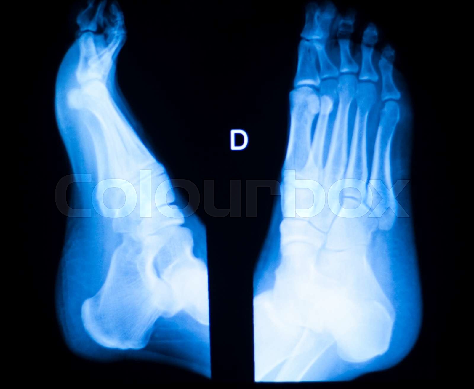 Foot and toes injury x-ray scan | Stock image | Colourbox