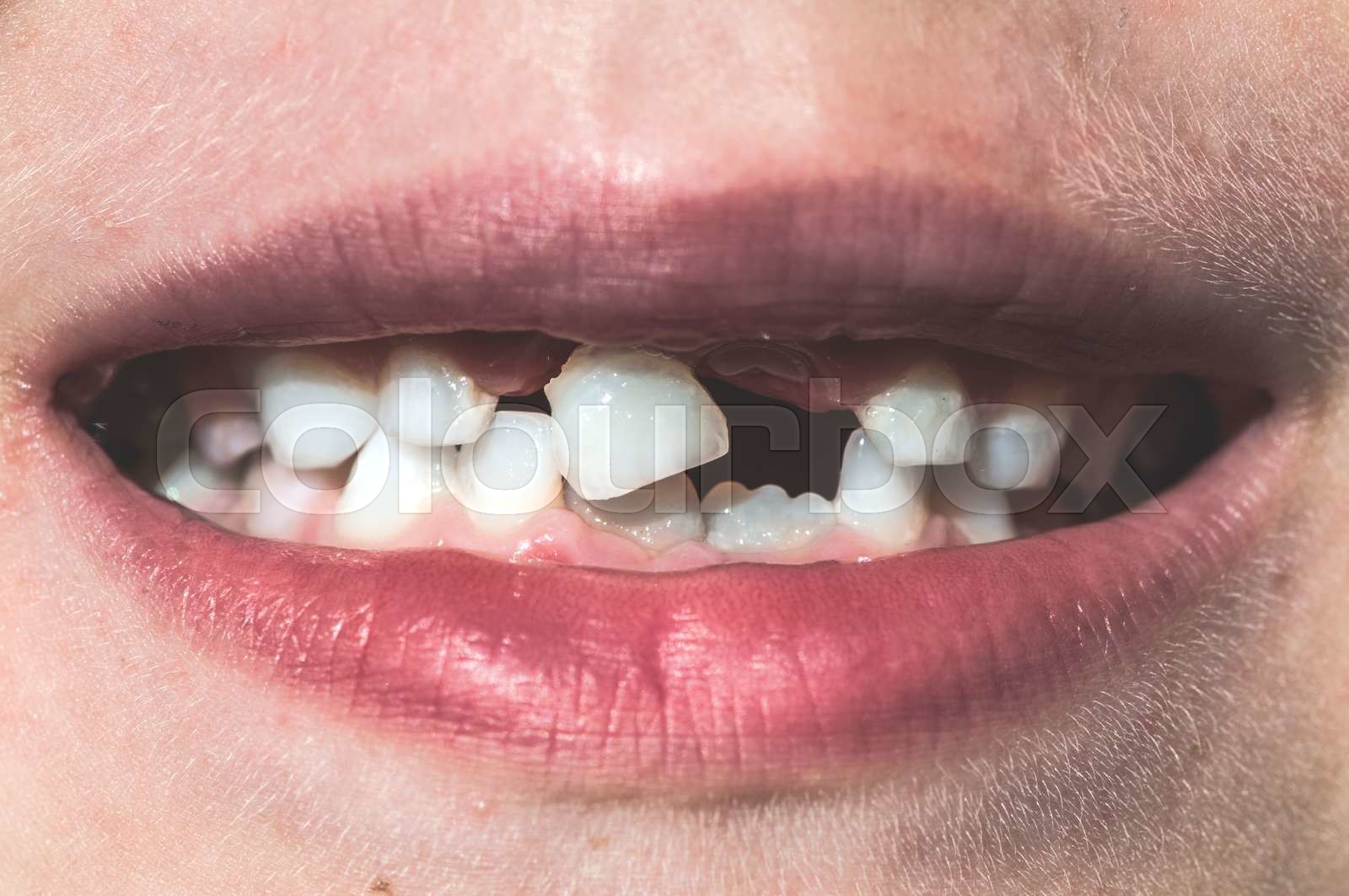 Child shows missing teeth | Stock image | Colourbox