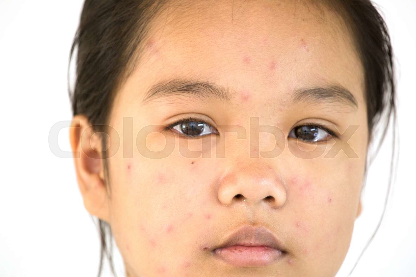 Lady to unhappy with chickenpox on face | Stock image | Colourbox