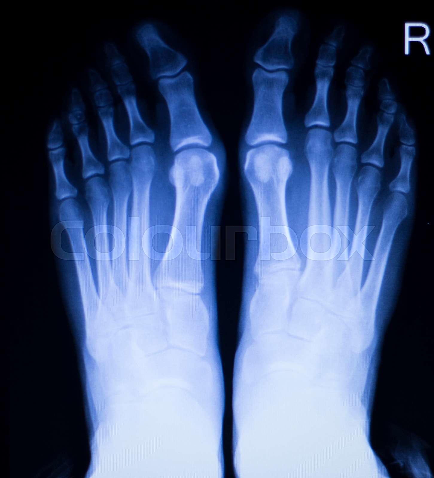 Foot and toes injury xray scan | Stock image | Colourbox