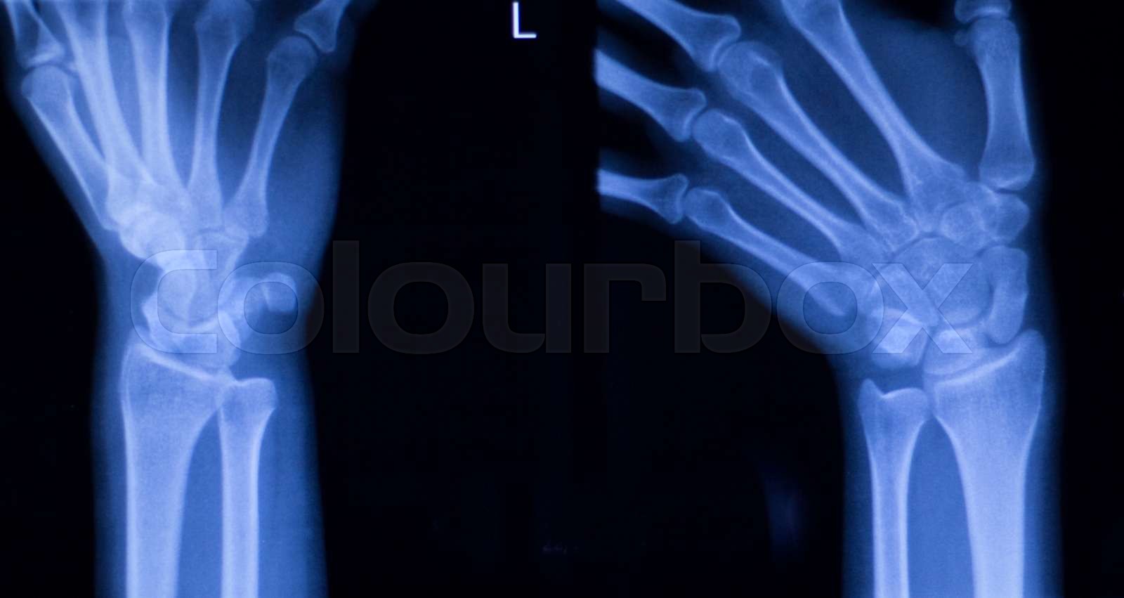 Hand fingers thumb wrist xray scan | Stock image | Colourbox