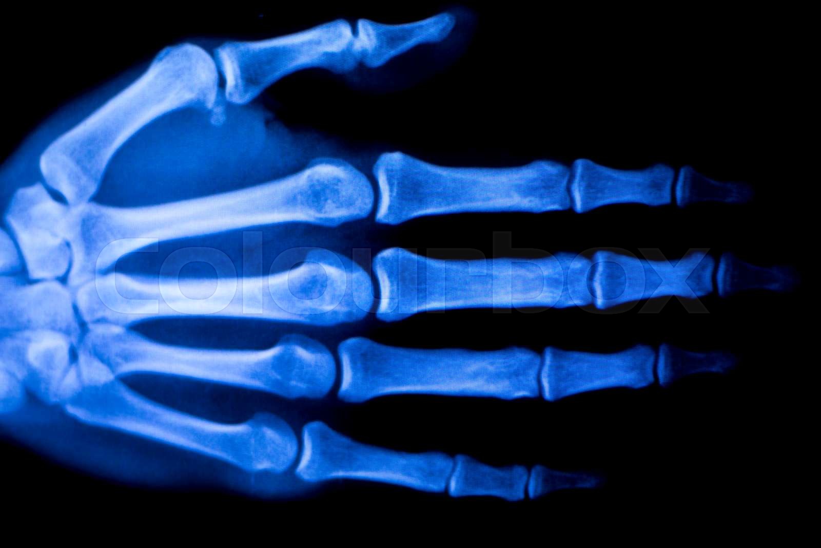 Hand fingers thumb wrist xray scan | Stock image | Colourbox