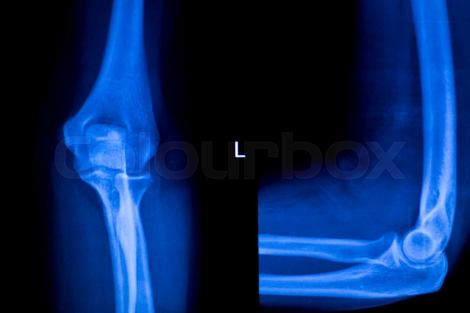 Elbow X Ray