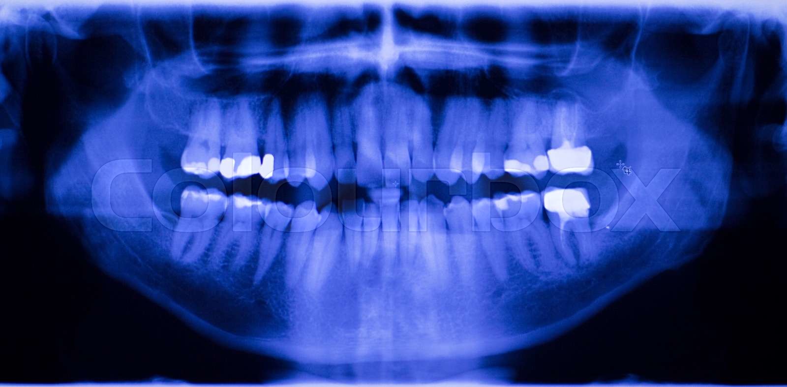 Dental teeth filling dentists xray scan | Stock image | Colourbox