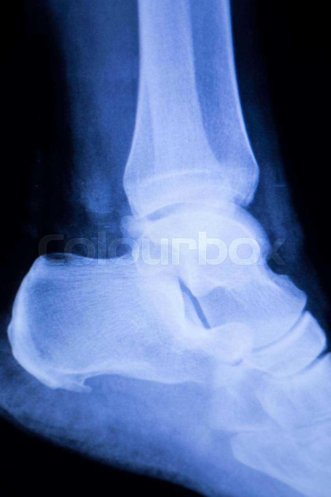 Foot heel ankle injury xray scan | Stock image | Colourbox
