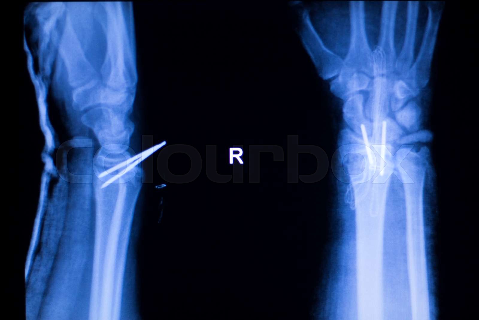 Forearm orthopedic implant xray scan | Stock image | Colourbox