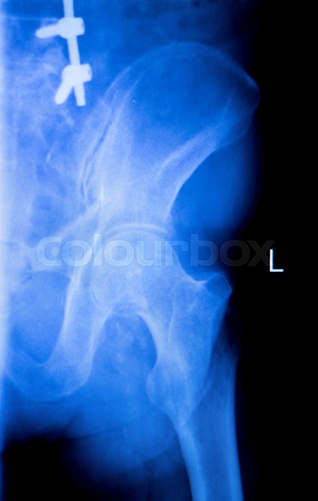 Hip replacement xray orthopedic medical scan | Stock image | Colourbox