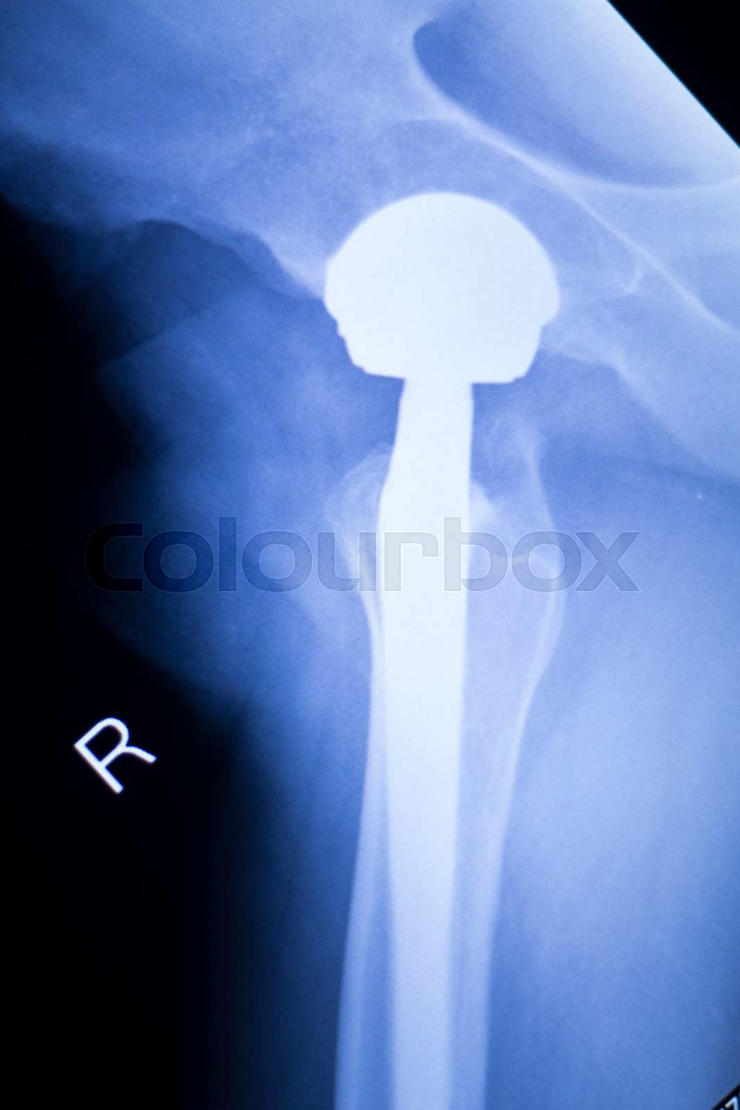 Hip replacement xray orthopedic medical scan | Stock image | Colourbox