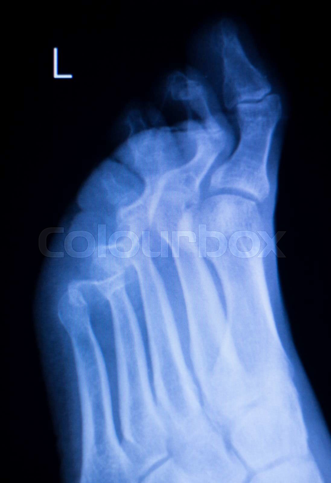 Foot and toes injury xray scan | Stock image | Colourbox
