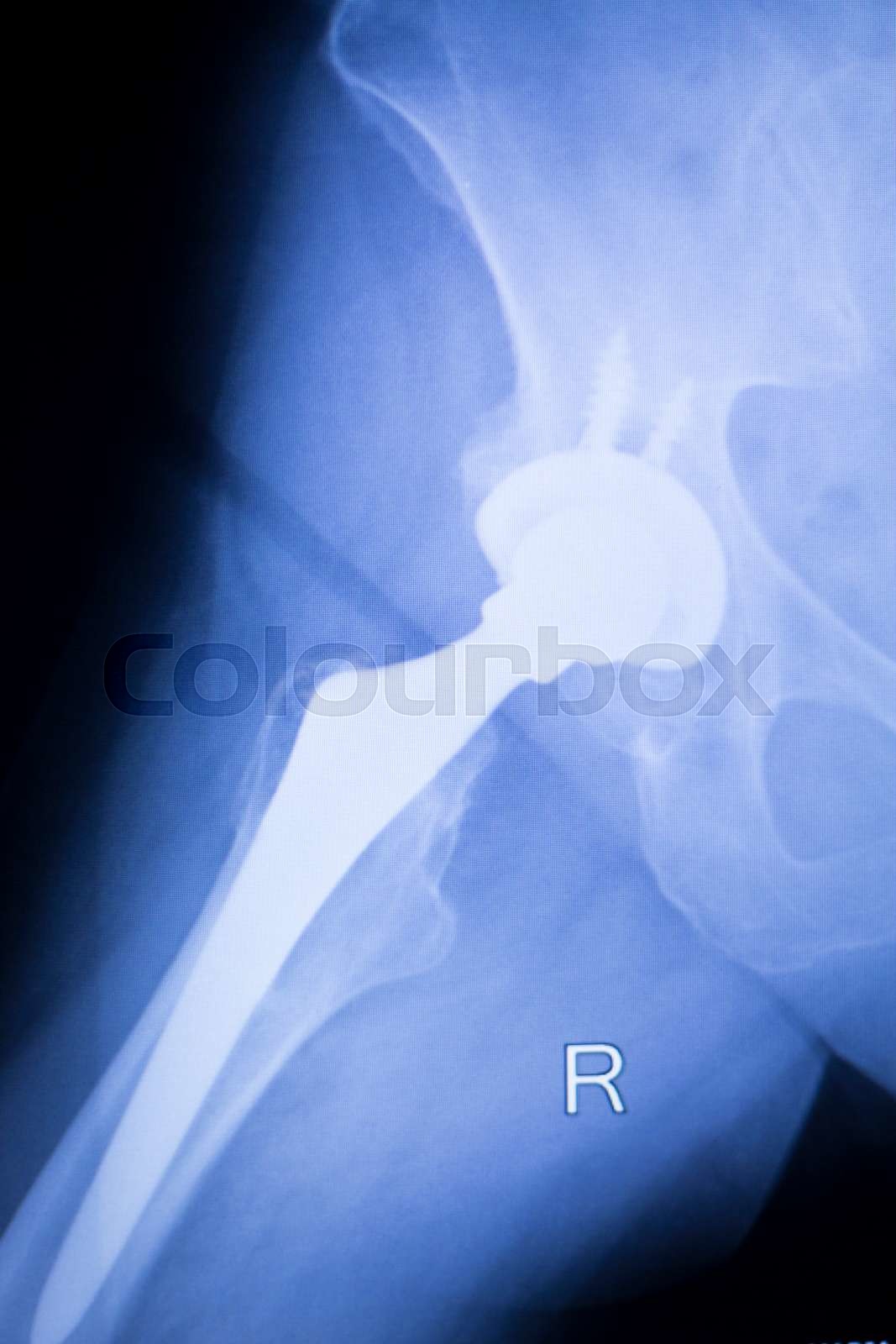 Hip replacement xray orthopedic medical scan | Stock image | Colourbox