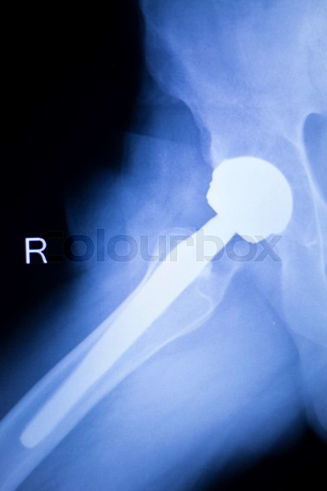 Hip Replacement Xray Orthopedic Medical Scan Stock Image Colourbox 5927