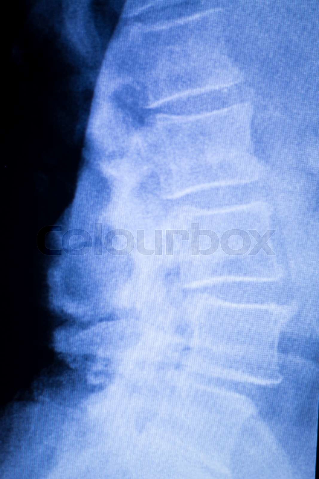 Spine vertebra back injury xray scan | Stock image | Colourbox