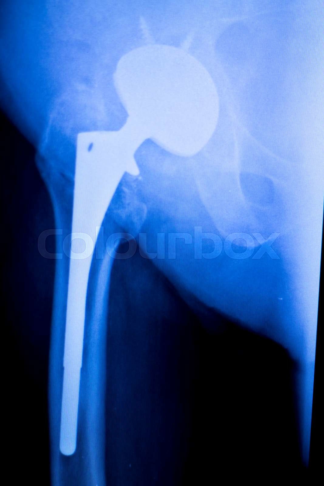 Hip replacement xray orthopedic medical scan | Stock image | Colourbox