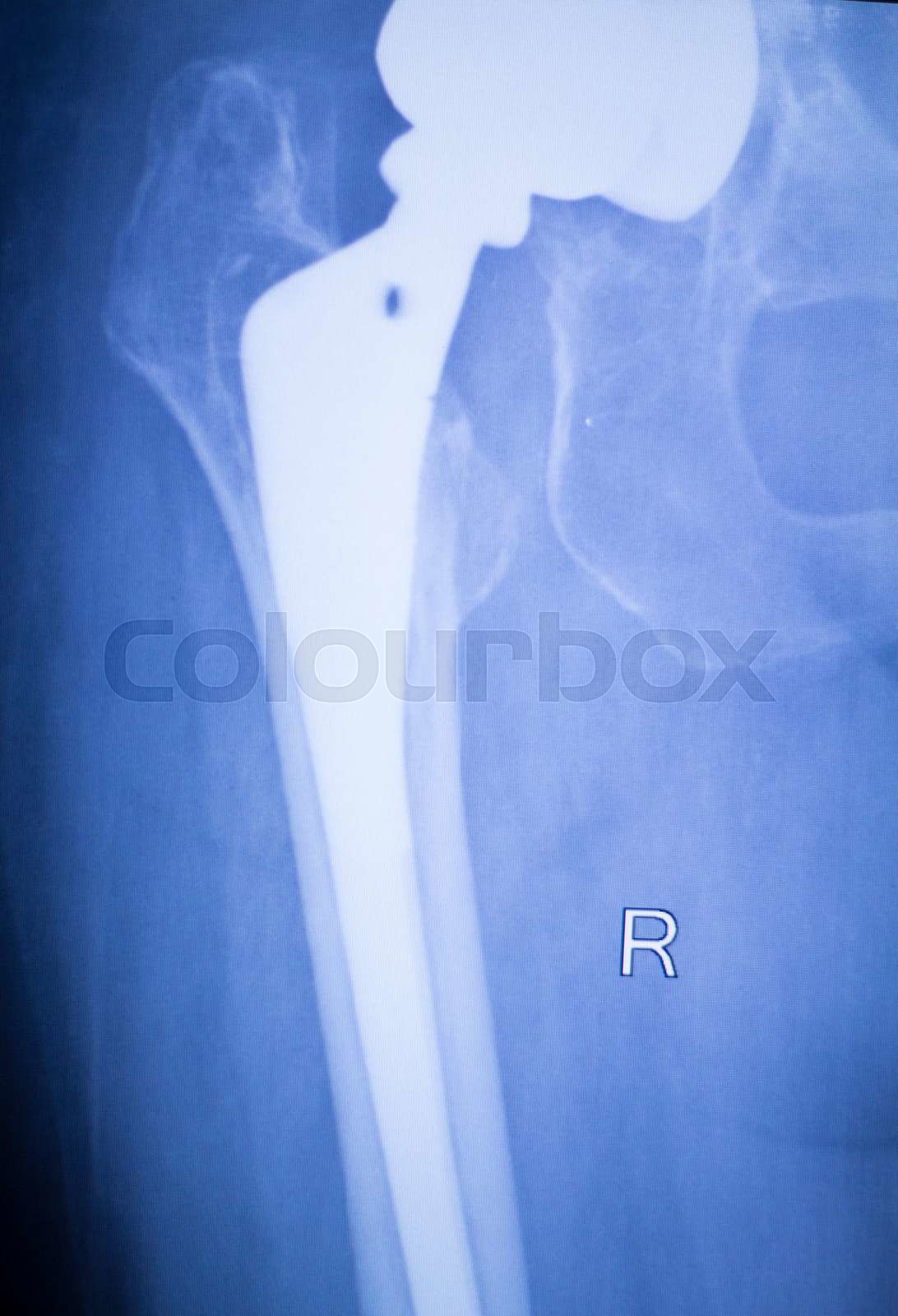 Hip Replacement Xray Orthopedic Medical Scan Stock Image Colourbox 2557