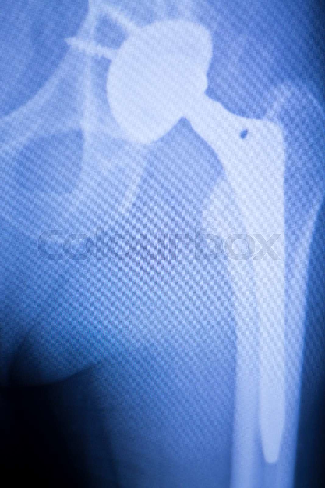 Hip replacement xray orthopedic medical scan | Stock image | Colourbox