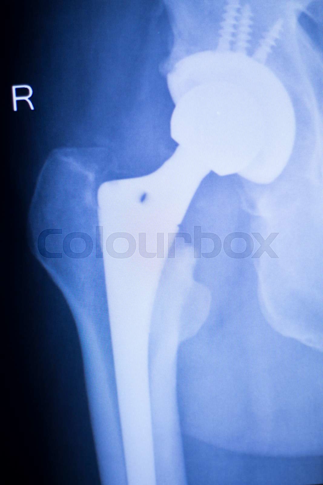 Hip replacement xray orthopedic medical scan | Stock image | Colourbox