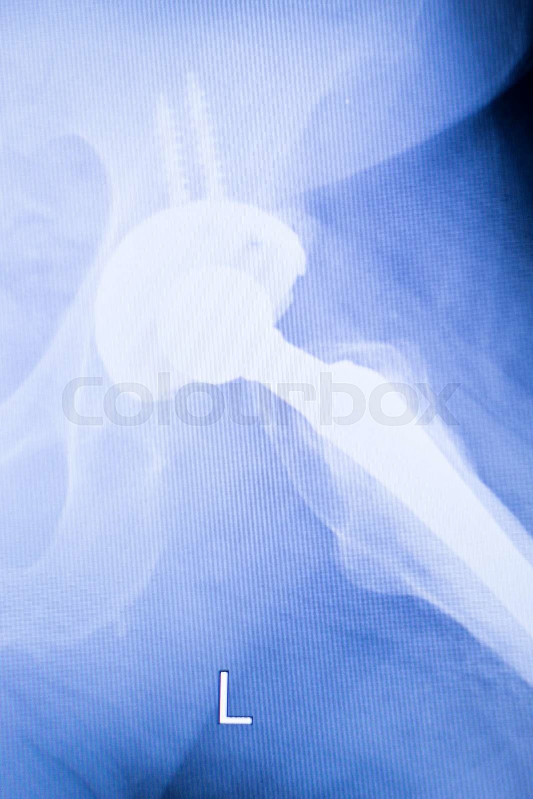 Hip replacement xray orthopedic medical scan | Stock image | Colourbox