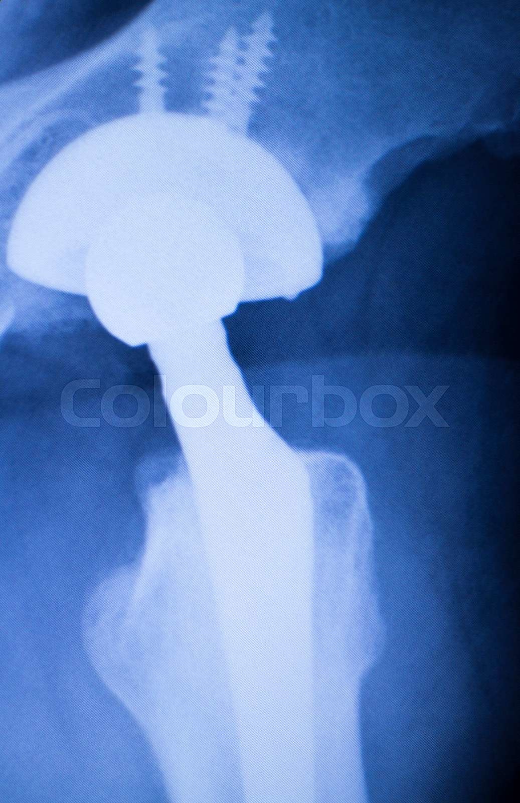 Hip replacement xray orthopedic medical scan | Stock image | Colourbox