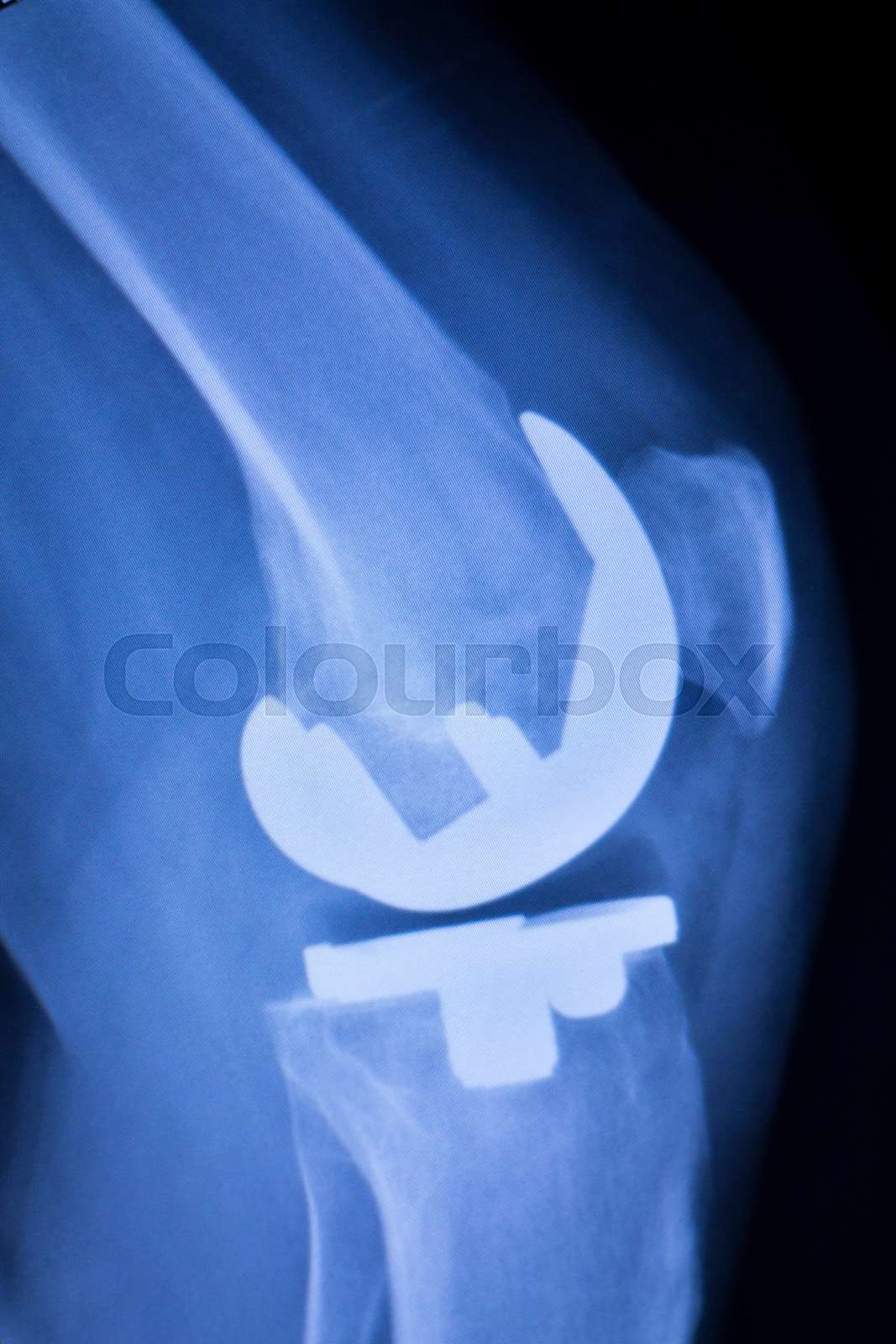 Knee orthopedic implant xray scan | Stock image | Colourbox